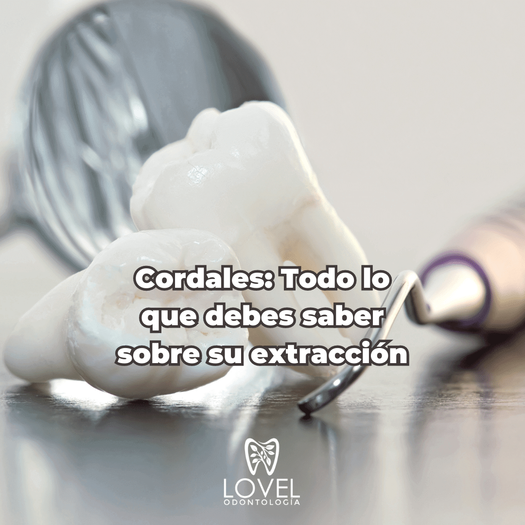 Extracción de Cordales